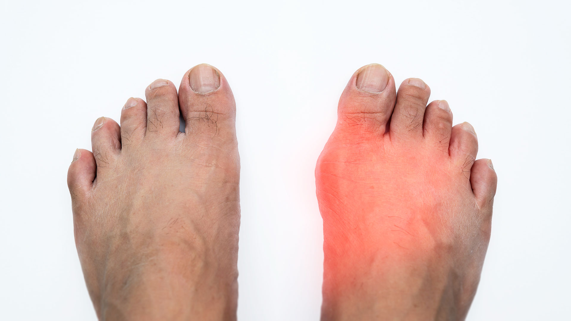 Kangestunud suurvarba operatsioon | Ortokliinik